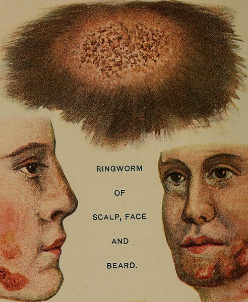 Best Home Remedies For Ringworm in Beard And On Face - Beard Oil Recipes